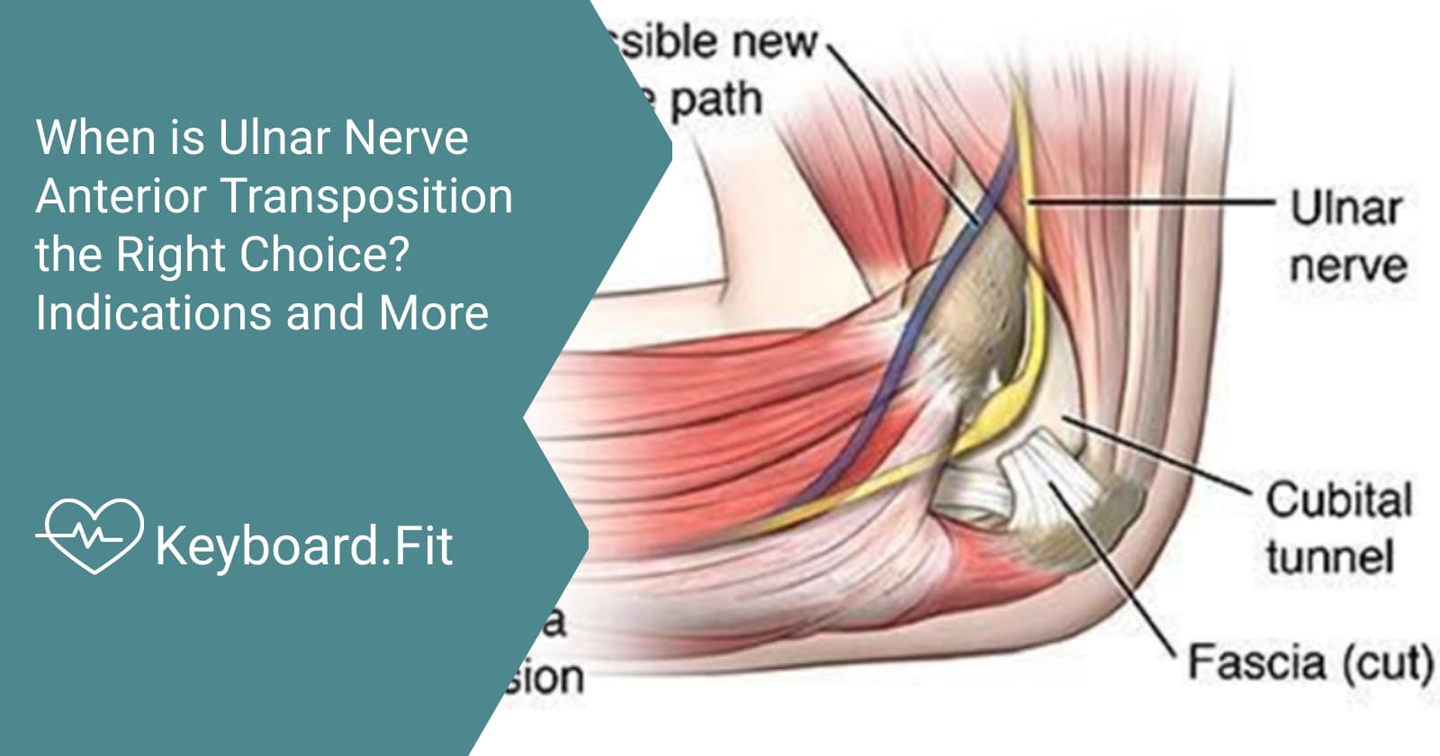 When is Ulnar Nerve Anterior Transposition the Right Choice? Indications and More - Keyboard.Fit