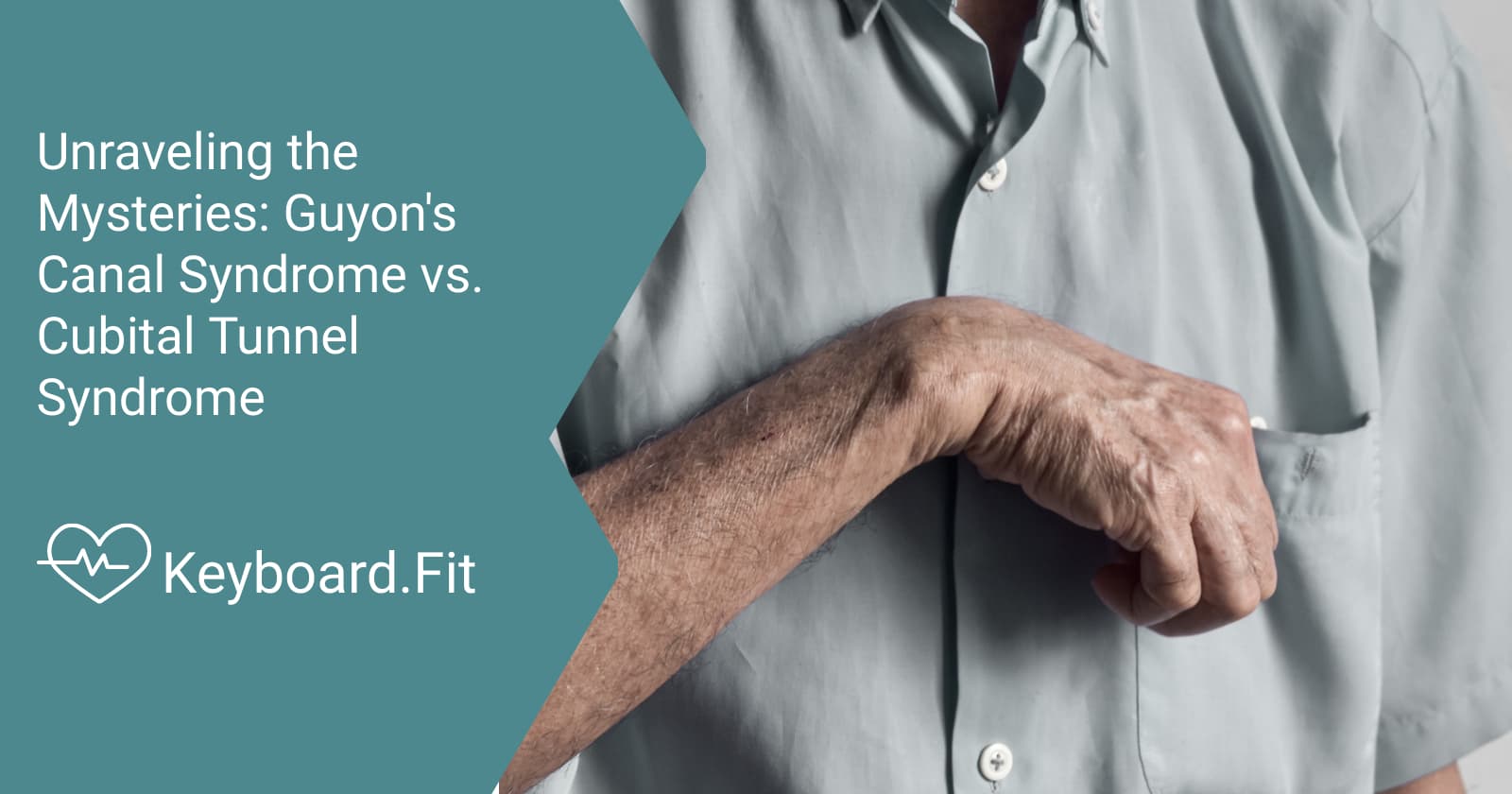 Unraveling the Mysteries: Guyon's Canal Syndrome vs. Cubital Tunnel ...